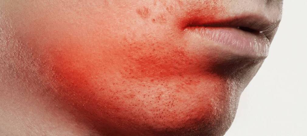 Why Is My Skin Red and Itchy - Dr. Shveta Sharma
